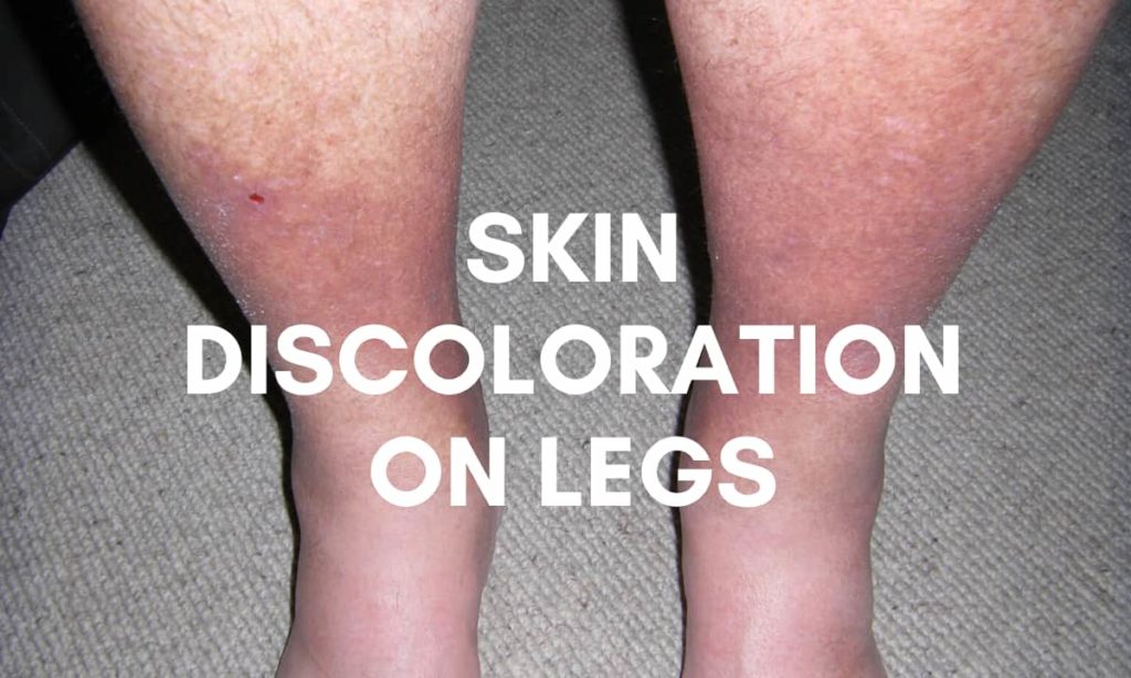 Skin Discoloration On Legs: Causes, Types & Treatments