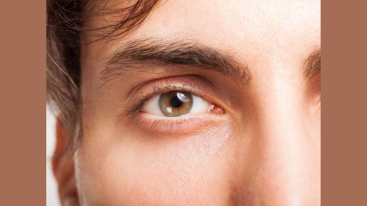 Are Dark Eyelids A Sign Of Anemia? Exploring the Link